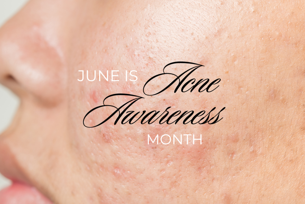 June is Acne Awareness Month - Dermatology & Laser of Alabama