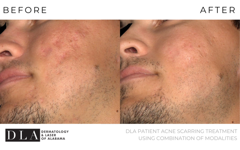 Introducing Acne Bootcamp - Dermatology & Laser of Alabama