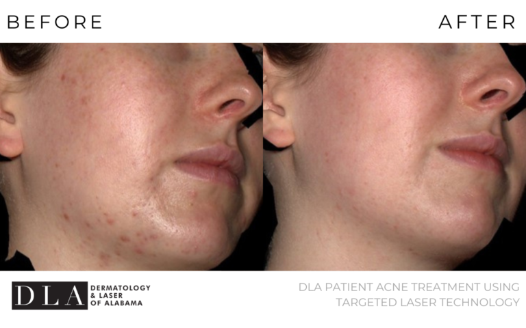 Introducing Acne Bootcamp - Dermatology & Laser of Alabama